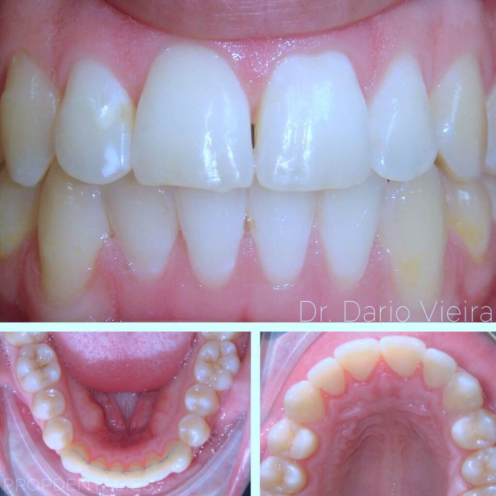 Estrategias para mantener dientes alineados después de ortodoncia ...